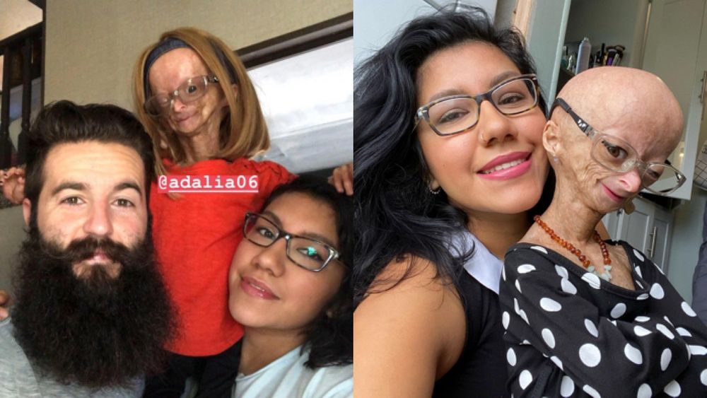 A closer look at Adalia Rose’s condition and her parents - TheNetline