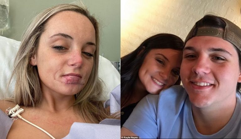 Kayla Hayes' story: She had her lip bitten off by an abusive ex ...