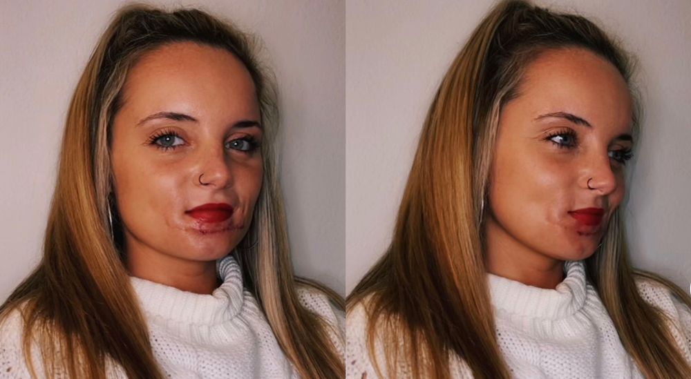 Kayla Hayes' story: She had her lip bitten off by an abusive ex ...