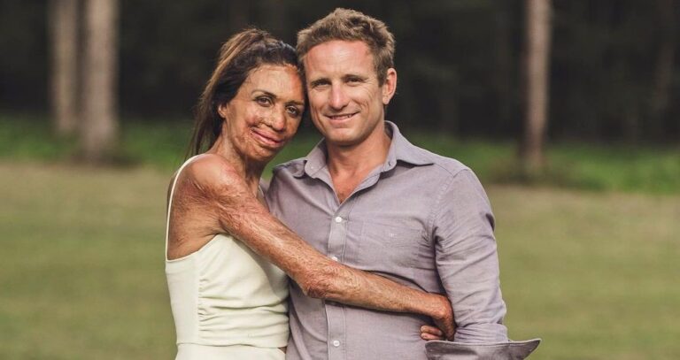 Turia Pitt's story — Her recovery from 65% burns - TheNetline
