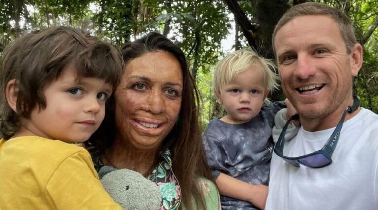 Turia Pitt's story — Her recovery from 65% burns - TheNetline