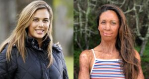 Turia Pitt's story — Her recovery from 65% burns - TheNetline