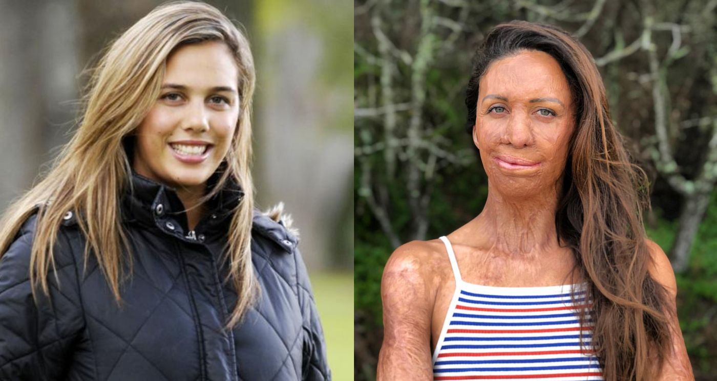 Turia Pitt's story — Her recovery from 65% burns - TheNetline